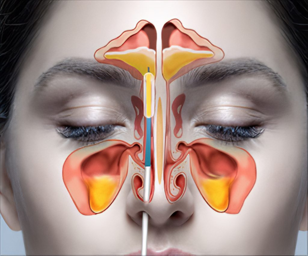 Sinusitis Treatment – Evren Ay Koc